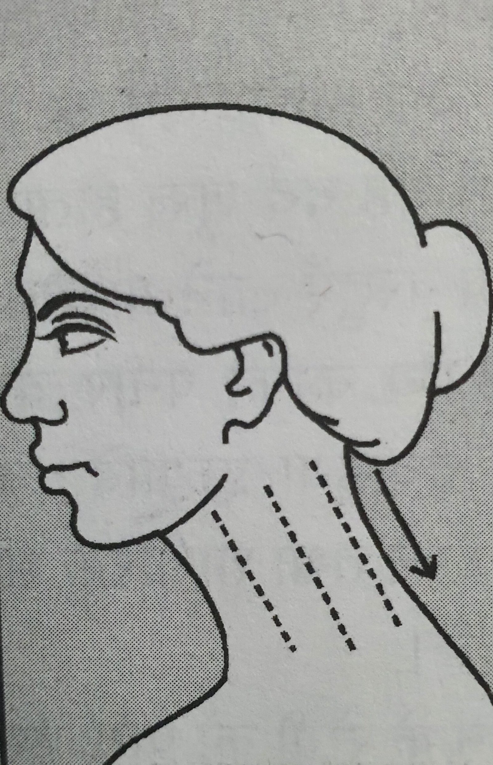 Acupressure treatment of Headaches & Migraine-Vacu Care Center